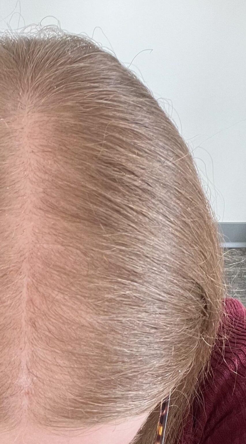 How to Stop Thinning Hair in Women: Proven Tips for Fuller Strands ...