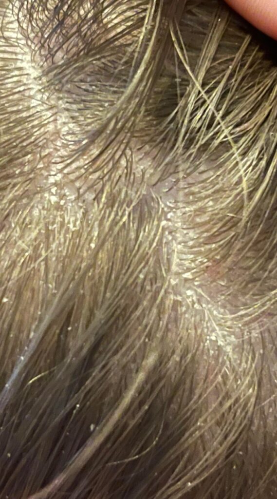 How to Get Rid of Dandruff: Proven Ways to Banish Flakes for Good ...