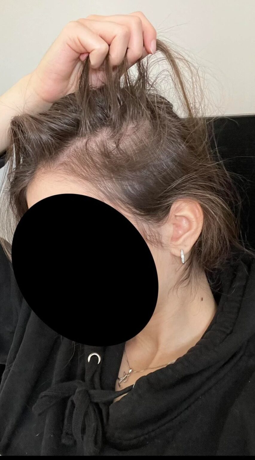 How to Stop Thinning Hair in Women: Proven Tips for Fuller Strands ...
