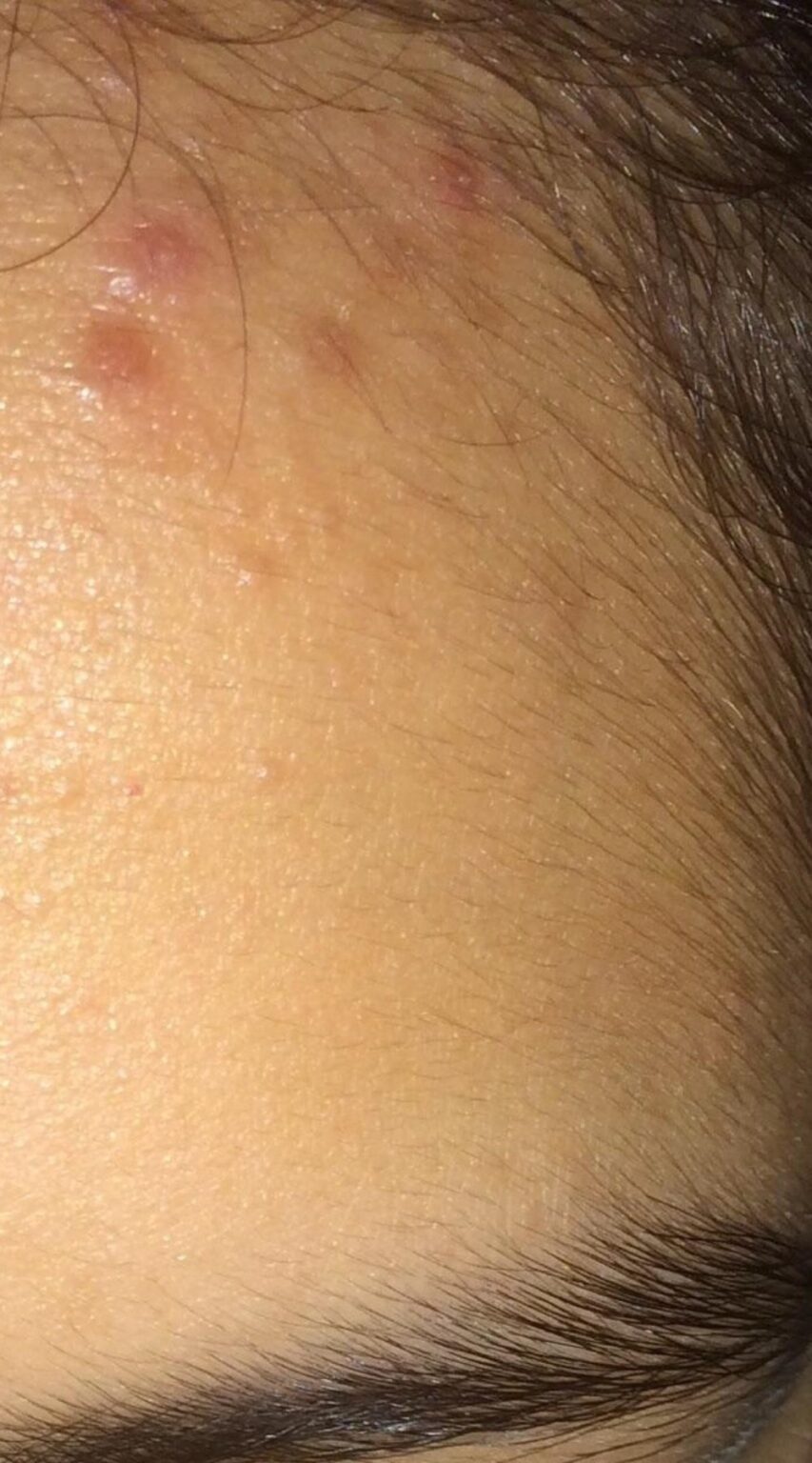 How to Get Rid of Pimples on Hairline: Clear Skin Secrets You Need to ...