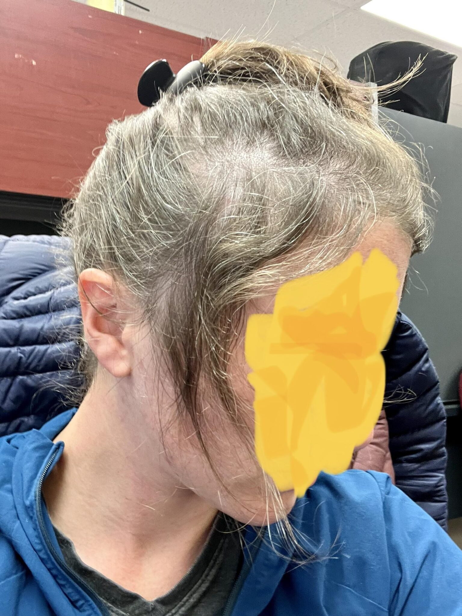 How to Fix Damaged Thin Hair: Simple Treatments That Actually Work ...