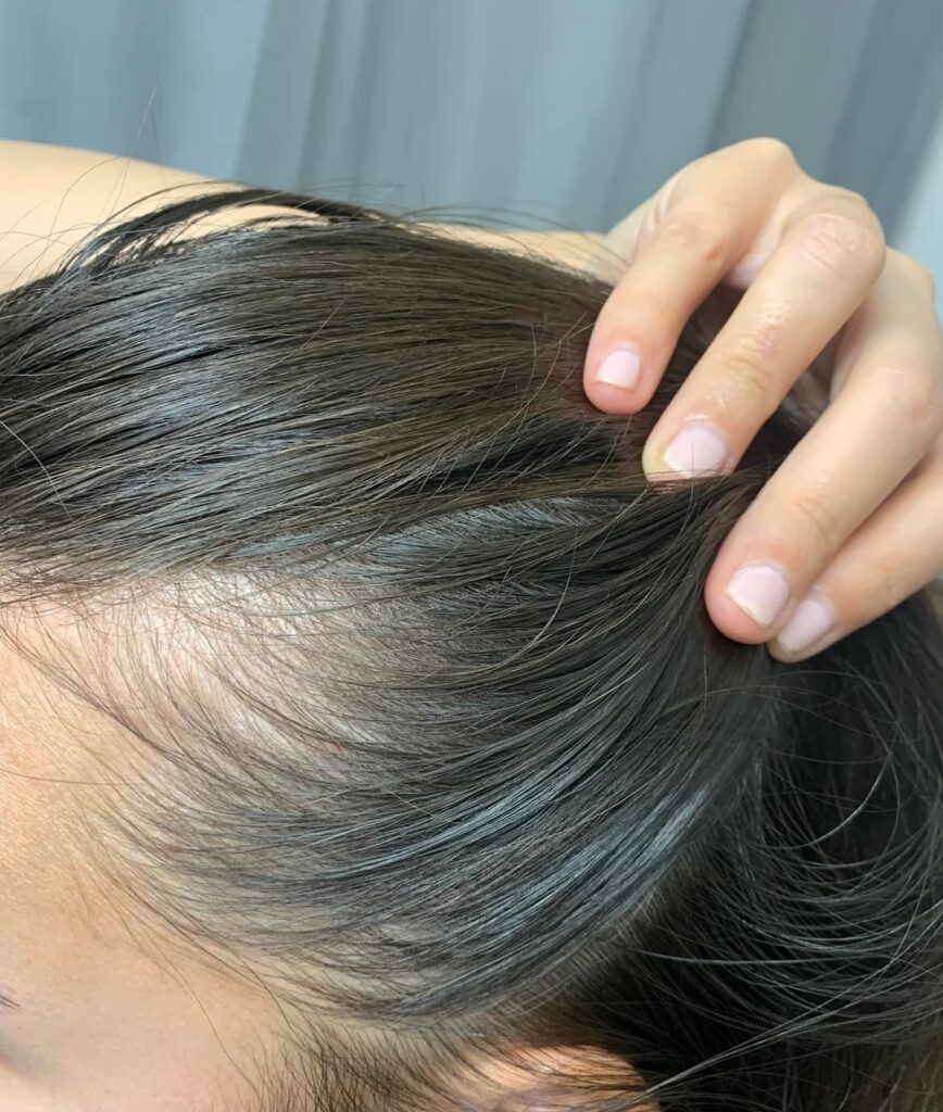 8 Vitamins for Thinning Hair for Women: What Really Works and Why It ...